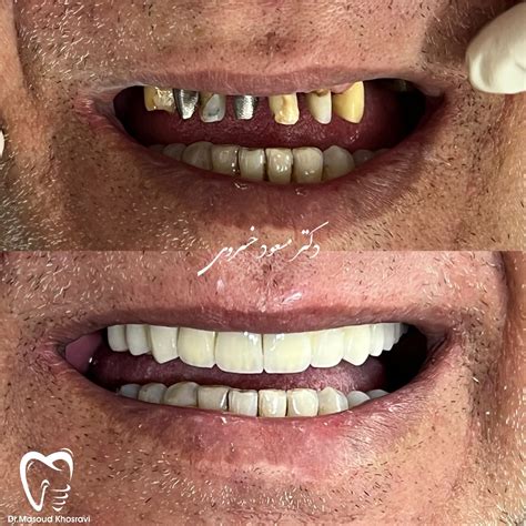 ‎دکتر مسعود خسروی دندانپزشک 🦷‎ Dr Masoud Khosravii • Instagram Photos And Videos