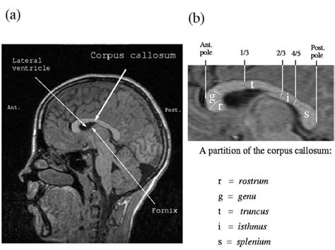 Radiological Anatomy Of The Brain Ppt