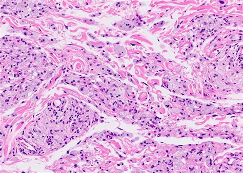 Xanthelasma And Xanthoma Skin Hub