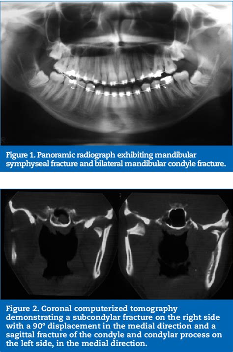 Figure 2 From Non Surgical Management Of Bilateral Mandibular Condyle