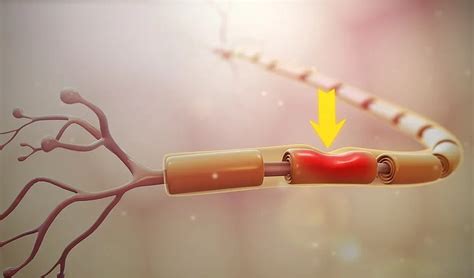 Neuropraxia Definition Archives Samarpan Physiotherapy Clinic