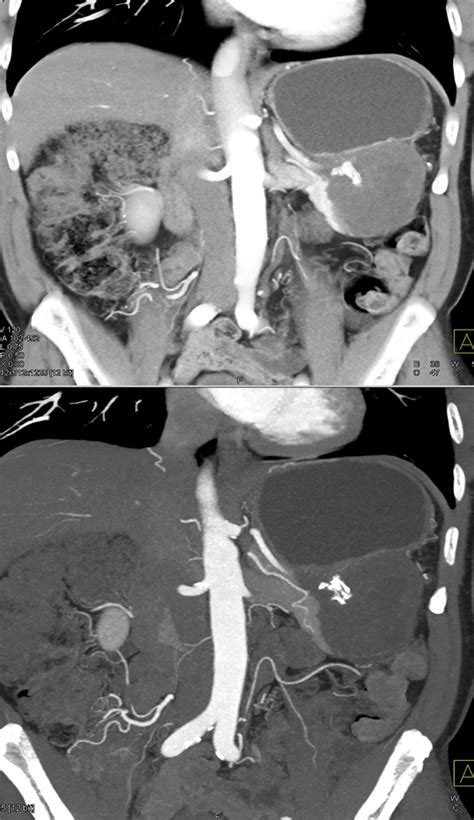 Gastrointestinal Learning Modules Ct Scanning