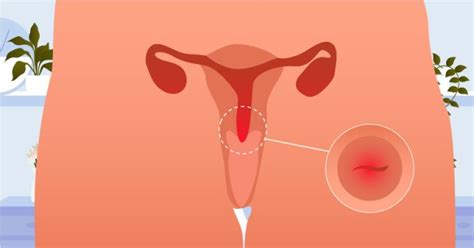 How To Prevent Vaginal Bleeding After Sex No More Mess