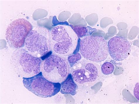 Megaloblastic Anaemia Due To Vitamin B12 Deficiency