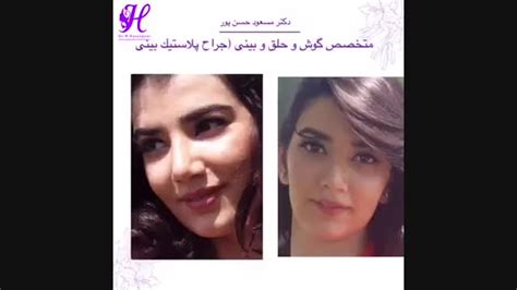 جراحی زیبایی بینی انجام شده توسط دکتر مسعود حسن پور نماشا