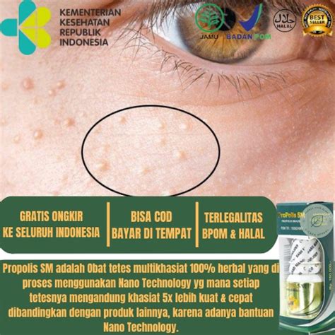 Jual Obat Milia Obat Milia Di Bawah Mata Milia Pada Wajah Milia Di