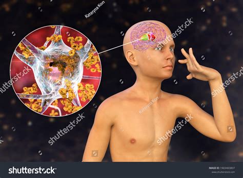 Antineuronal Antibodies Antibasal Ganglia Antibodies 3d Stock