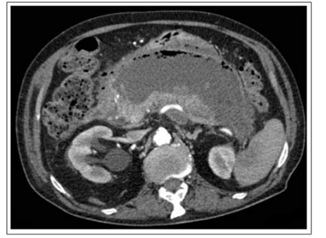 Fulltext Sitagliptin Induced Acute Necrotizing Pancreatitis A Case
