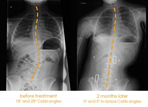 Scoliosis Case Histories