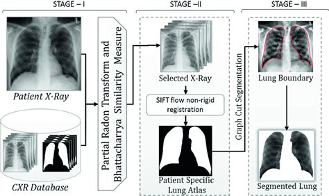 Github Asifikbal1pneumonia Detection Using Deep Learning In Tensorflow Keras Python