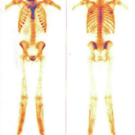 Ct Scan Of The Skull Showing Diffuse Skull Bone Thickening Download Scientific Diagram
