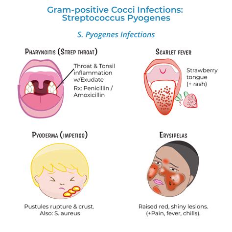 Streptococcus Bacterial Infection