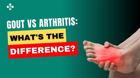 Gout Vs Arthritis Is There A Difference