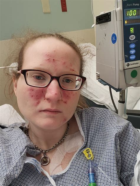 Just Dx Today Through Skin Biopsy Last Week R Rosacea