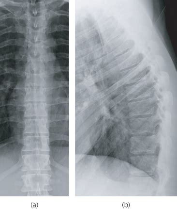 Lateral Thoracic Spine X Ray Hot Sex Picture