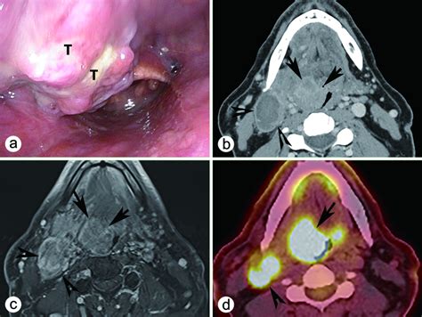 Oropharyngeal Squamous Cell Carcinoma A A 66 Year Old Male With A