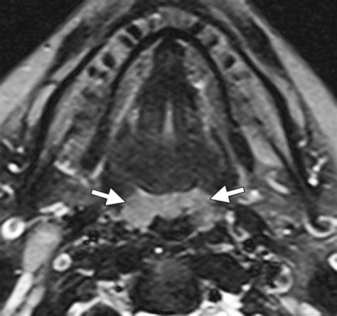 Lingual Tonsils Mri