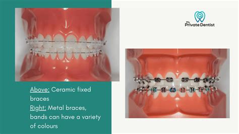 Ceramic Braces Pros And Cons Cost And Photos
