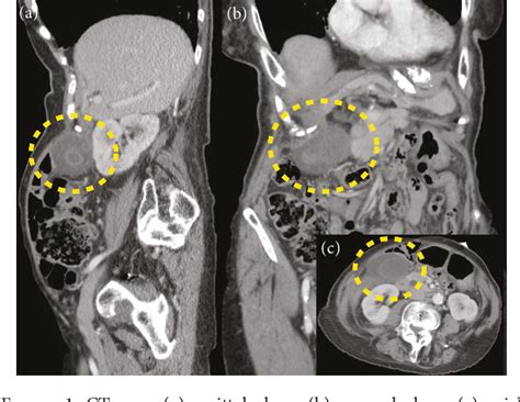 Figure 1 From First Report Of Gallbladder Volvulus Managed With A Robotic Approach Semantic