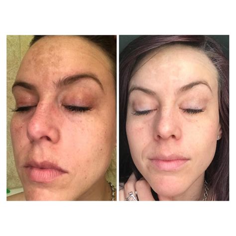 کرم ویتامین سی اوردینری ٪۲۳ و ۲٪ هیالورونیک اسیدبهترین قیمتاصل کانادا