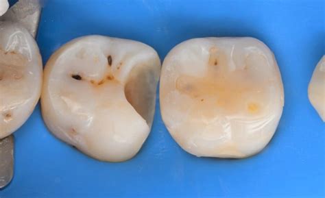 Class Ii Adjacent Cavities On 1st And 2nd Molars With Myquickmat Prime