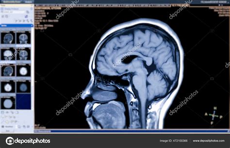 Irm Vue Sagittale Cerveau Pour Détecter Une Variété Conditions Cerveau