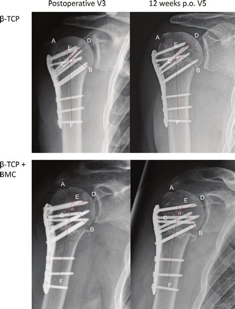 Representative Radiographs Of Surgically Treated Proximal Humerus Download Scientific Diagram
