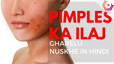 Pimple Treatment In Hindi Beauty Tips In Hindi Muhase Ka Ilaj For Oily Skin YouTube