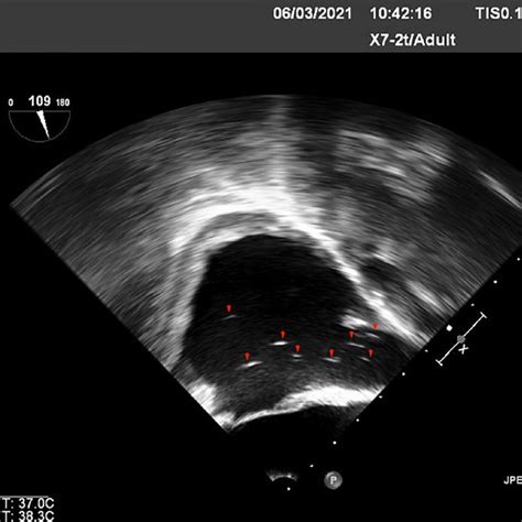 Injury To The Right Prostatic Venous Plexus During Singleport