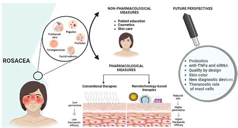 Rosacea Topical Treatment And Care From Traditional To New Drug