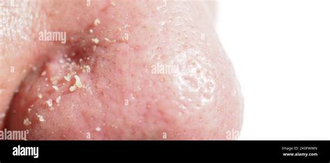 Acne And Problem Pores Squeezing Blackhead Pimple With Stainless Steel
