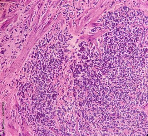 Anal Canal Ulcer Biopsy Chronic Nonspecific Proctitis Show Anal