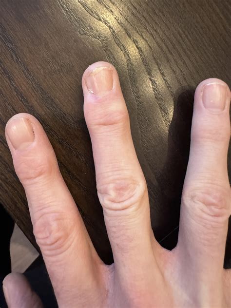 Ana Pattern Question R Scleroderma