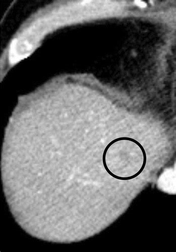 Ct Noise Reduction Methods For Lower Dose Scanning Strengths And Weaknesses Of Iterative
