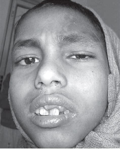 Figure 1 From Sturge Weber Syndrome Presenting With Intractable