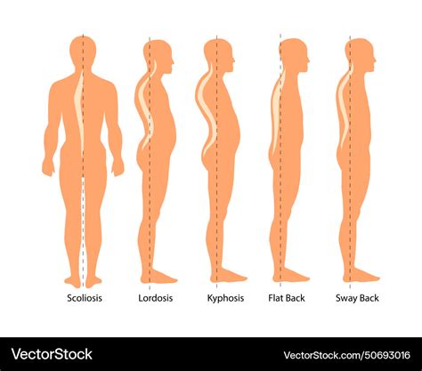Medical Of Spinal Deformity Types Royalty Free Vector Image