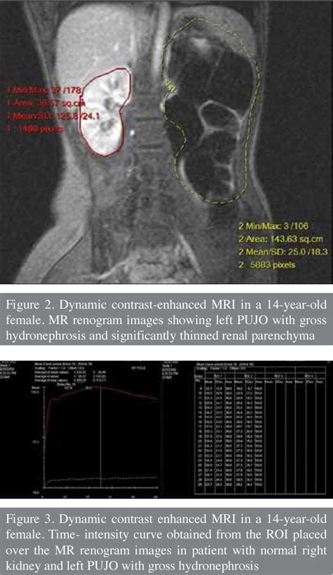 Figure 2 From Dynamic Mri And Isotope Renogram In The Functional