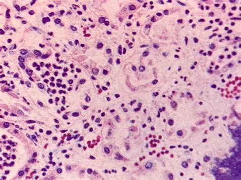 Tubulointerstitial Diseases Terminology U Tubulointerstitial Nephritis