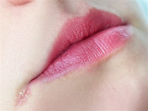 8 Natural Treatments For Cracked Mouth Corners Angular Cheilitis