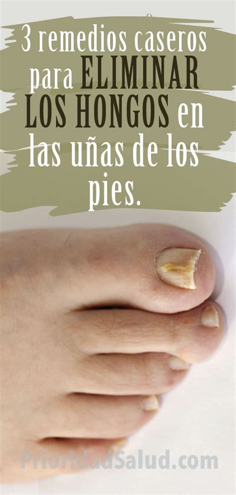 3 remedios caseros para eliminar los hongos en las uñas de los pies
