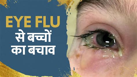 Eye Flu Treatment सावधान बच्चों में तेजी से फैल रहा Eye Flu जानें