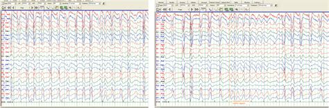Clinical Outcome Of Generalized Periodic Epileptiform Discharges On