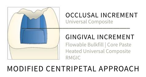 Closing The Class 2 Restoration Box Part 2 Management Of Direct Resin Spear Education