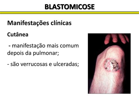 Blastomicose Manifestaç