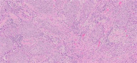 Human Lung Squamous Cell Carcinoma Ffpe Sections
