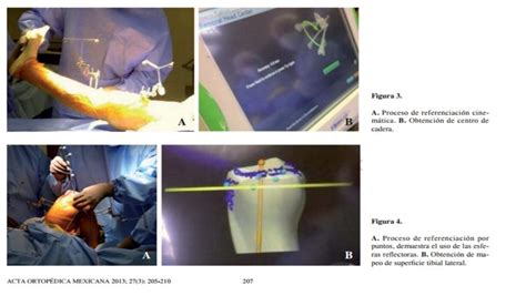 Artroplastía total de rodilla navegada Por qué utilizarla