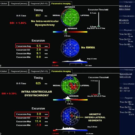 A Parametric Image Shows No Regional Wall Motion Abnormality With Download Scientific Diagram