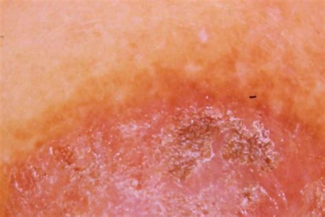 Breast Eczema Symptoms Causes And Treatment