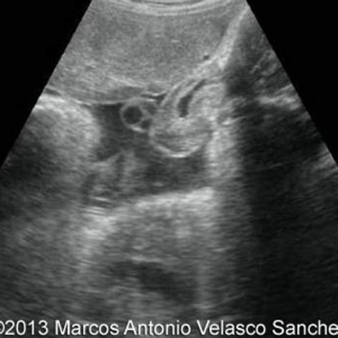 📃 Cephalocele Anterior