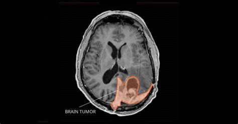 Meningioma National Cancer Institute